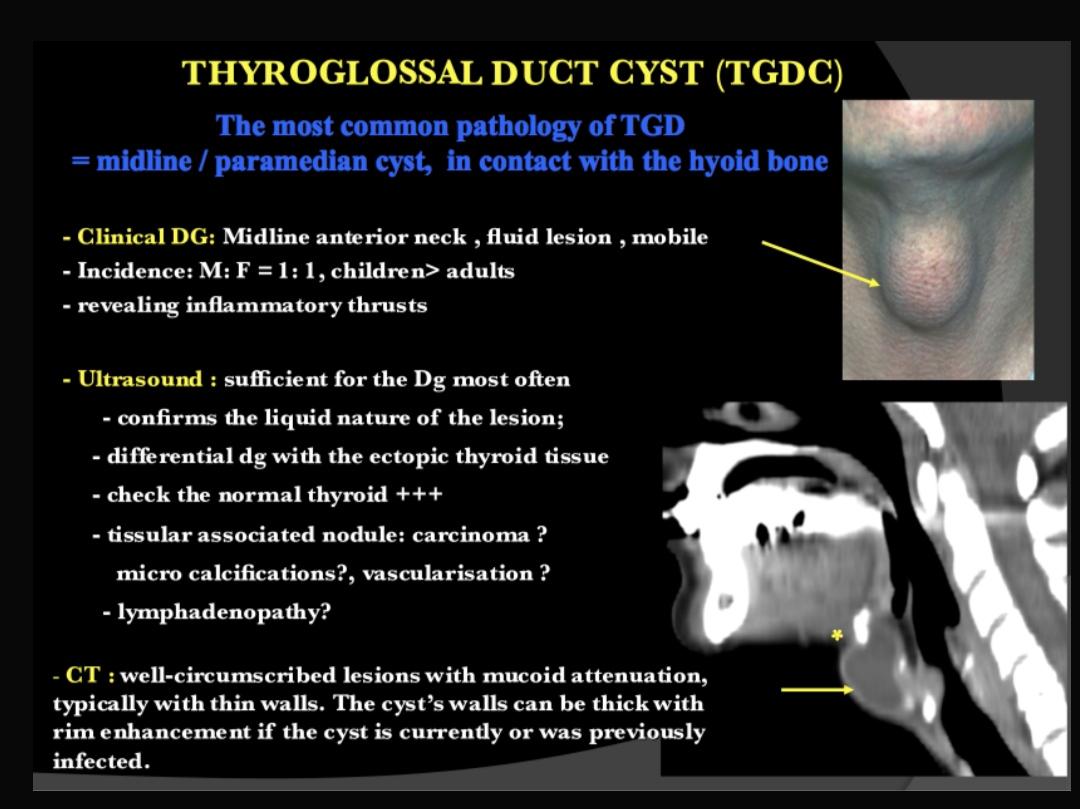 Thyroglossal Duct Cyst Ultrasound