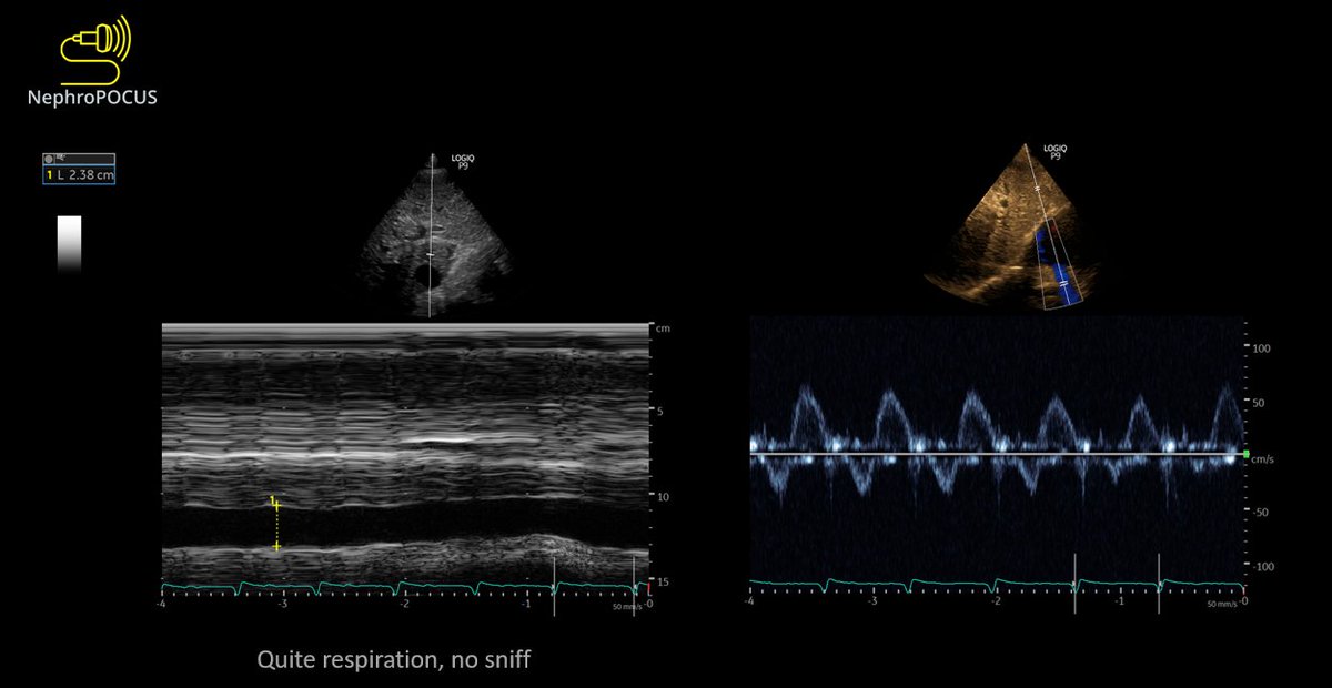 Interpretation of this hepatic vein #VExUS? Corresponding portal vein ...