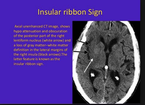Insular Ribbon Sign