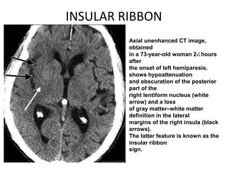 Insular Ribbon Sign