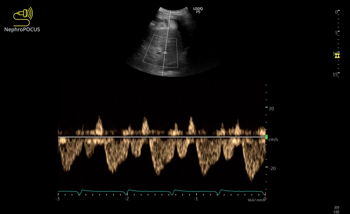 Interpretation of this hepatic vein #VExUS? Corresponding portal vein ...