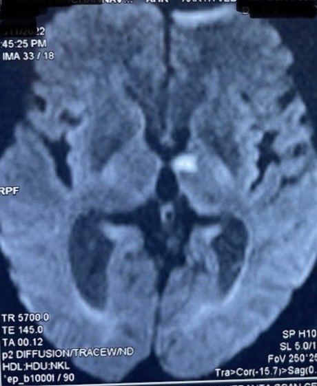 Thalamic amnesia / Strategic infarct dementia Patient presented with ...