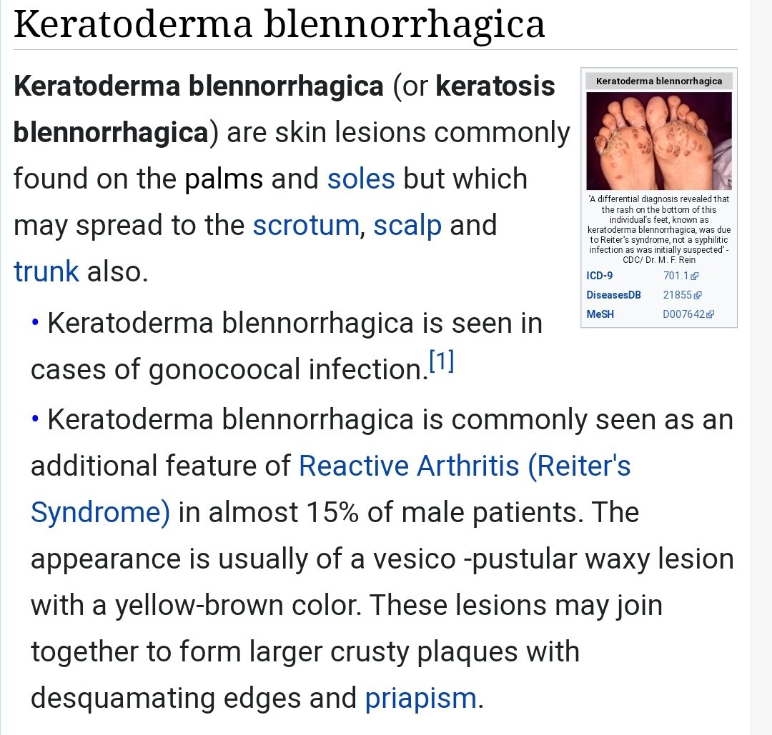 Keratoderma Blennorrhagica Scalp