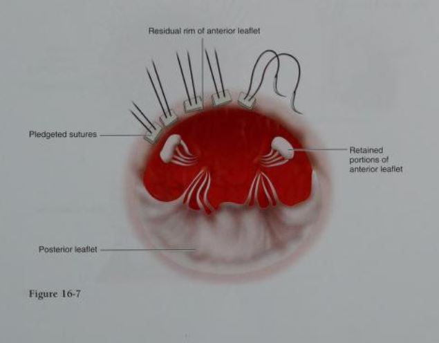 🧵of 🧵 In the past, we've covered most of the commonly used sutures ...