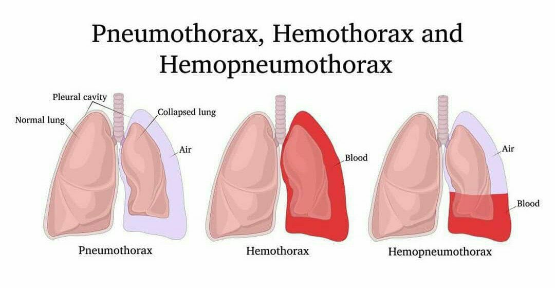 Hemothorax Vs Pneumothorax