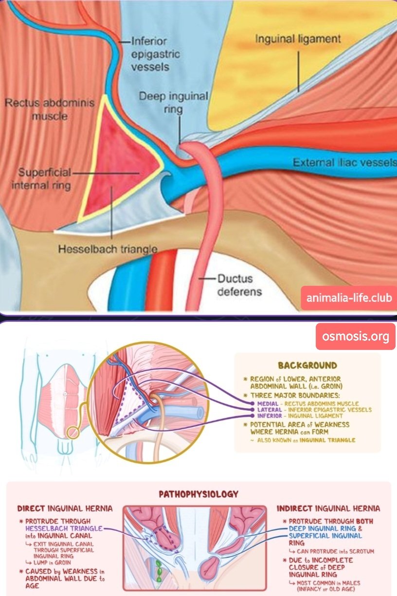 Direct Inguinal Hernia Anatomy Hernia Surgery Inguinal, Hiatus