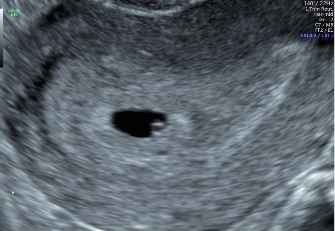 4 Week Ultrasound Pictures