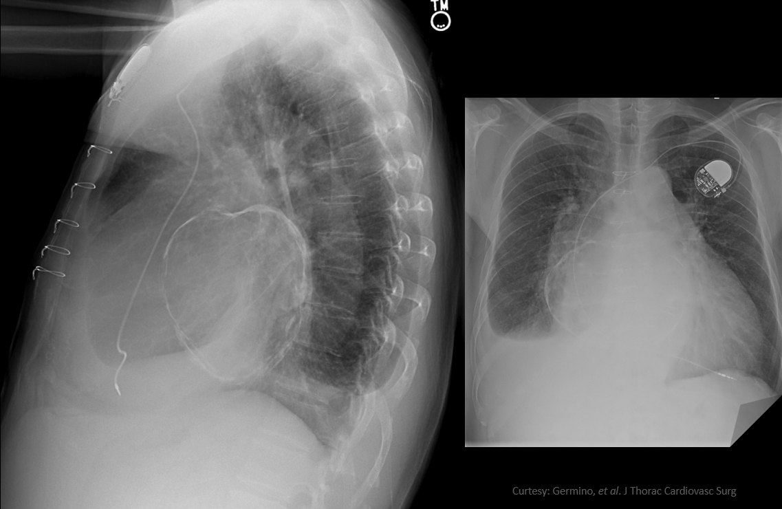 Aortic Stenosis X Ray