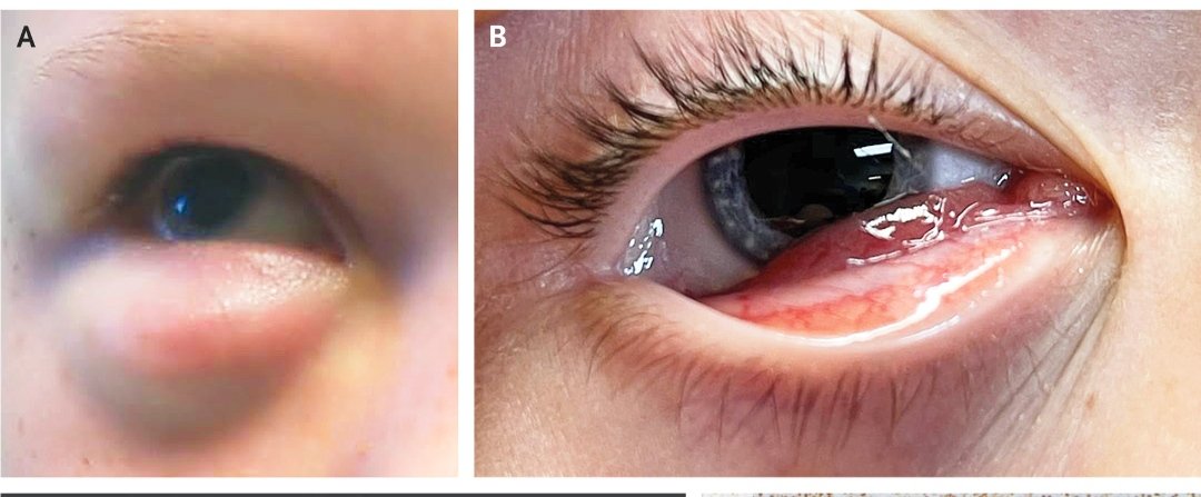 A previously healthy 8-year-old boy 👉2-week history of painless ...