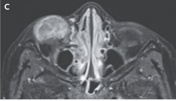 A previously healthy 8-year-old boy 👉2-week history of painless ...
