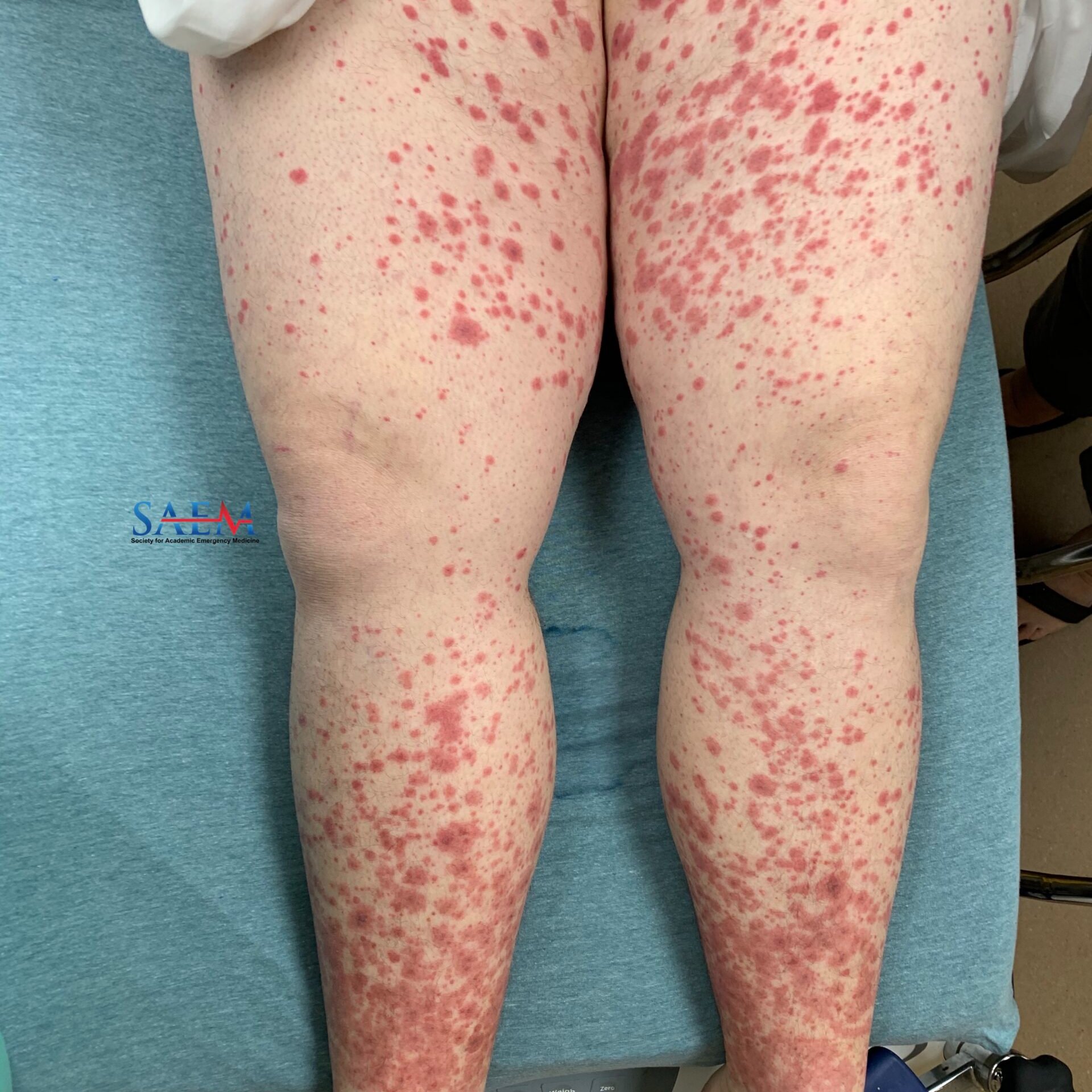 Shingles Leg
