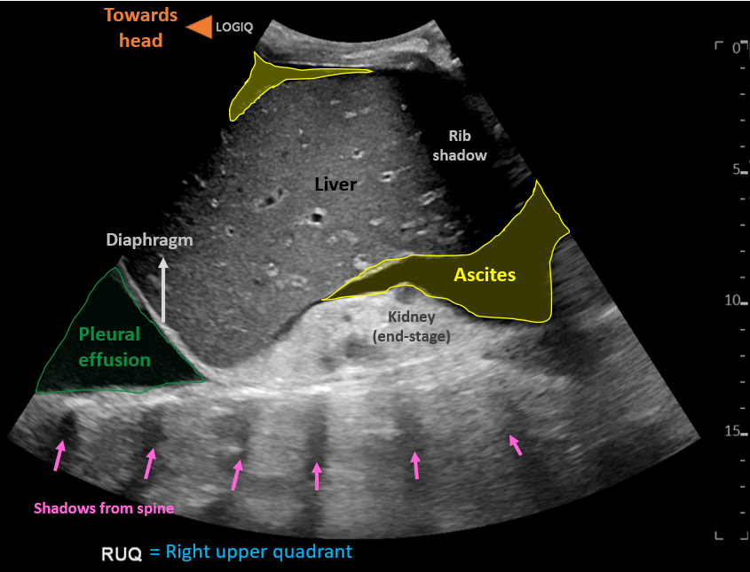 Ascites Vs Pleural Effusion Ultrasound