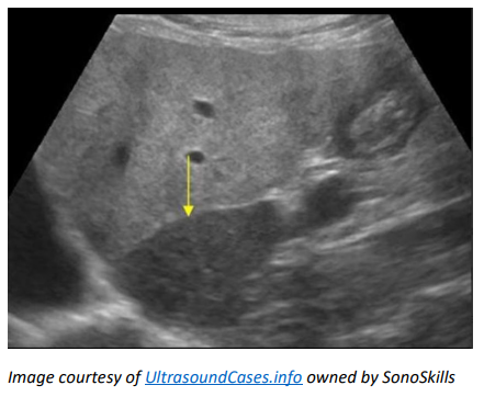 Caudate Lobe Of Liver Ultrasound