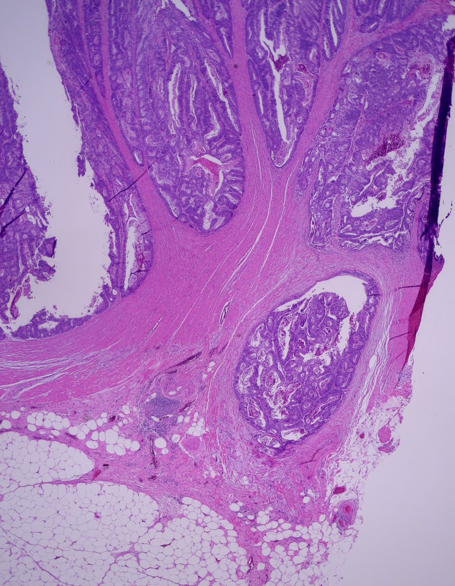 Tristan Rutland Mbbs Frcpa Ifcap On Twitter Rt Teclis82 Gipath Surgpath Pathresidents