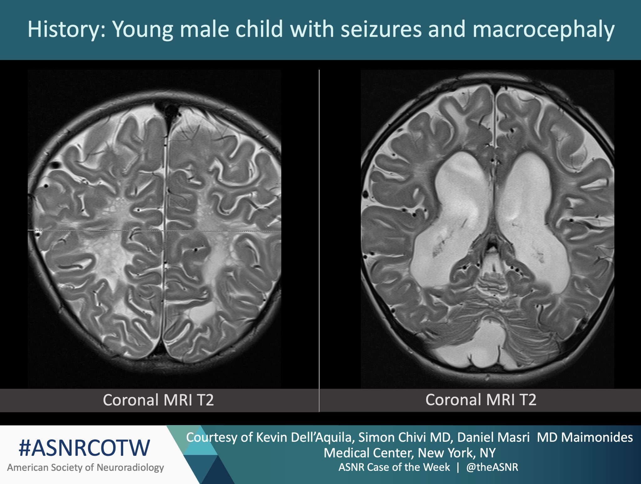 Macrocephaly Mri Early Diagnosis Of Malan Syndrome In An Infant