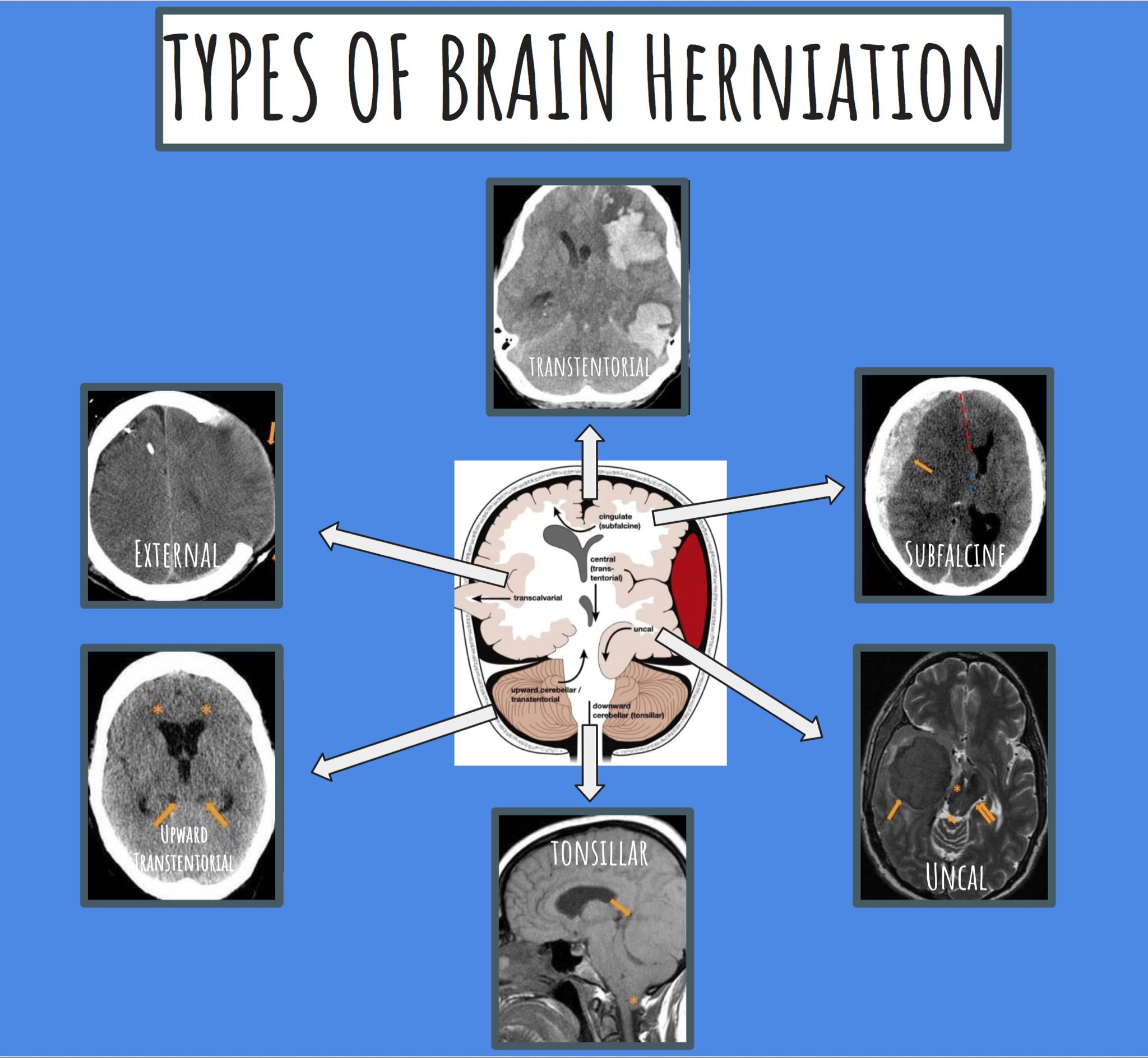 Central Herniation