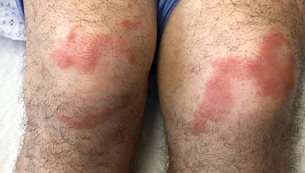 Erythematous Plaques