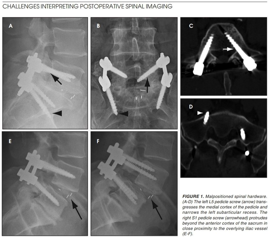 Common challenges in post-operative spinal imaging Pedicle screws ...