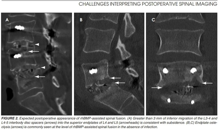 Common challenges in post-operative spinal imaging Pedicle screws ...
