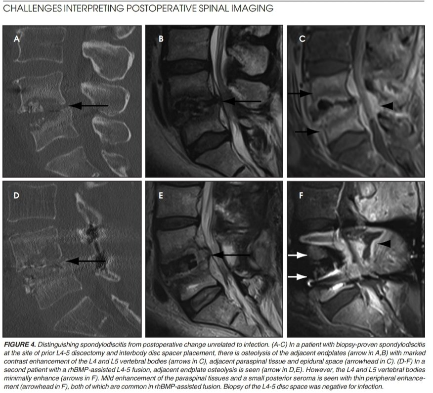 Common challenges in post-operative spinal imaging Pedicle screws ...