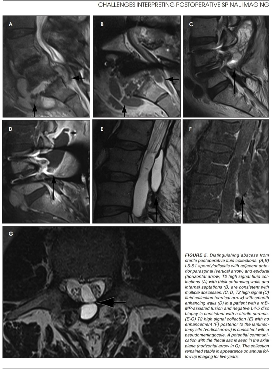 Common challenges in post-operative spinal imaging Pedicle screws ...
