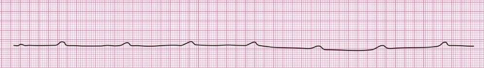 P Wave Asystole