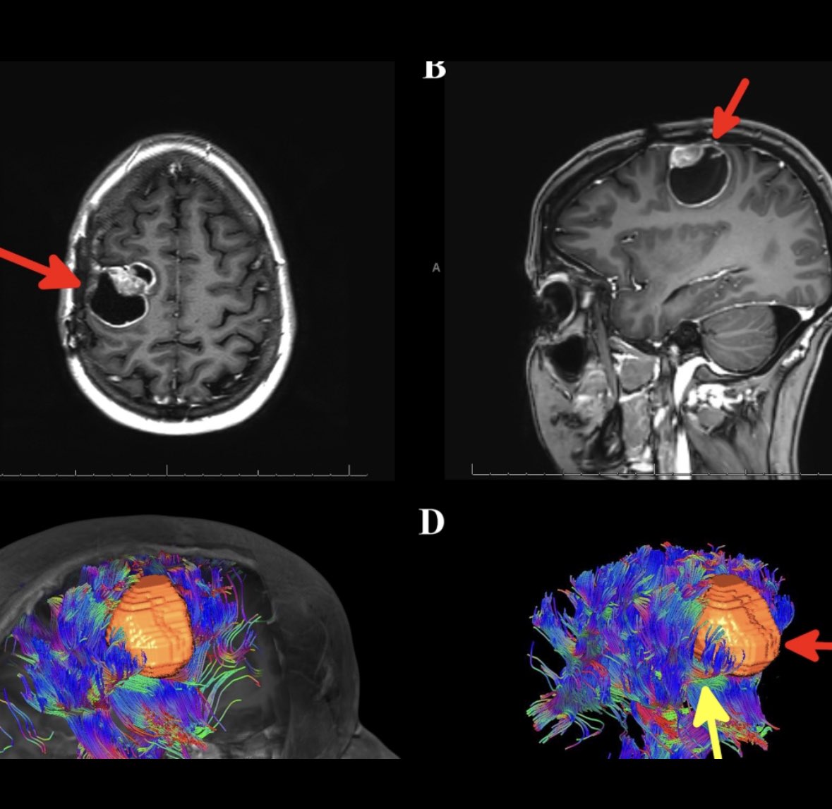 Radrounds Radiology Network On Twitter Tumor Abscess Or