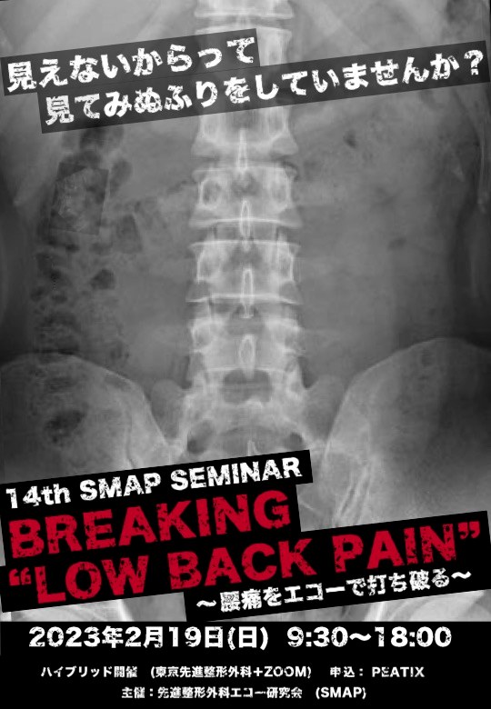 Sentinel Loop Appendicitis