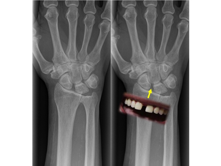 Fall onto an outstretched hand A gap there... What is the sign ...