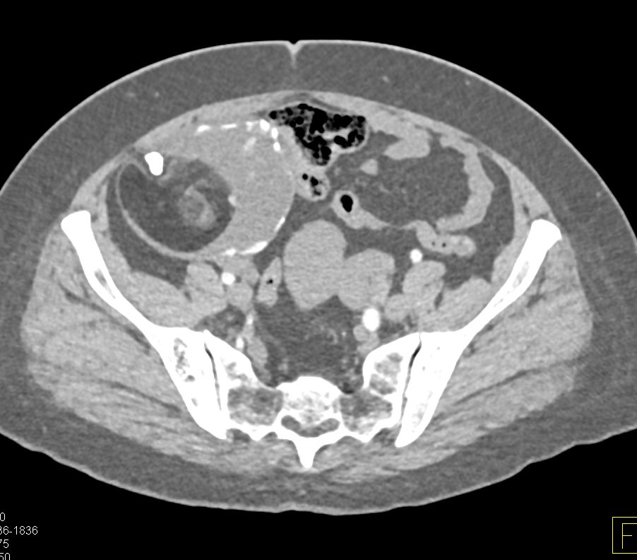 Elliot K Fishman CTisus On Twitter Acute Torsion Of A Dermoid elliot-k-fishman-ctisus-on-twitter-acute-torsion-of-a-dermoid