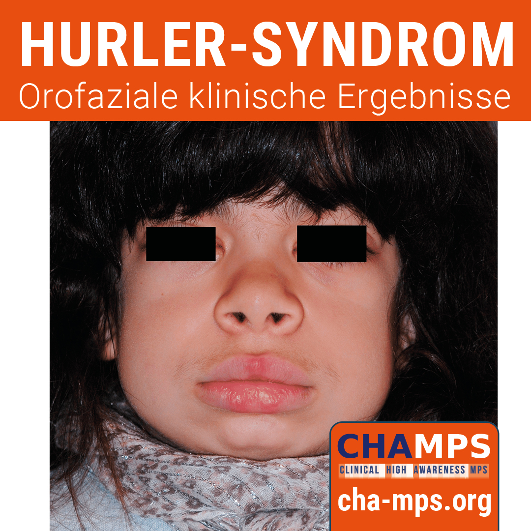 Hurler Syndrome