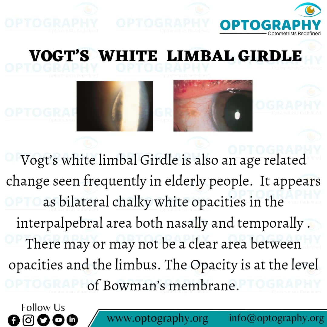 Limbal Girdle Of Vogt