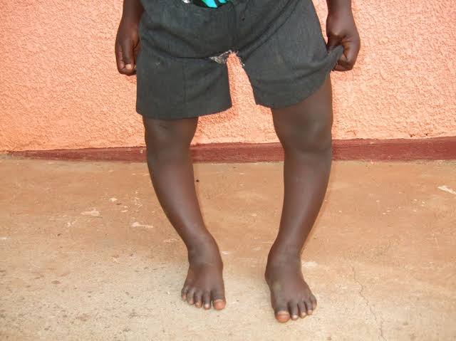 Question of the Day He has Bow Legs. What Vitamin is probably lacking ...