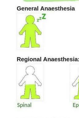 CAESAREAN SECTION - What is it? How is the procedure done? How to ...