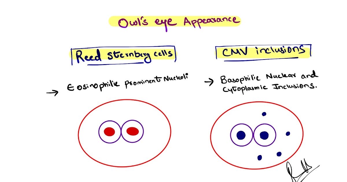 Reed Sternberg Cells Vs Cmv