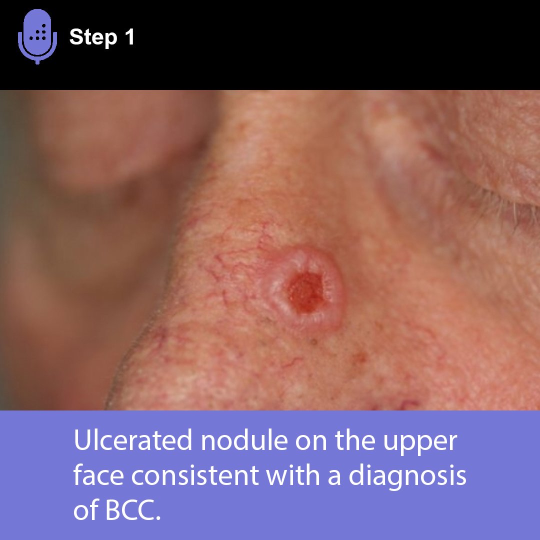 Basal Cell Carcinoma Vs Squamous Cell Carcinoma Usmle