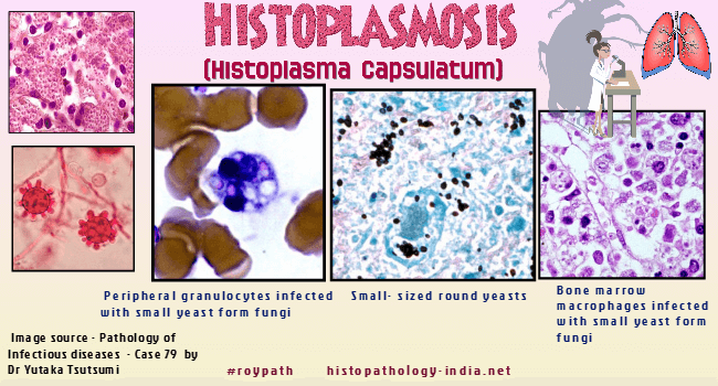 Histoplasma Capsulatum Macrophage