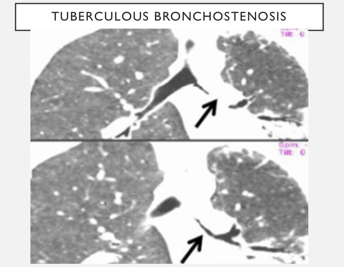 Dr Khaled Ahmed Abuzeid on Twitter: "Tuberculous bronchostenosis may cause post-obstructive ...