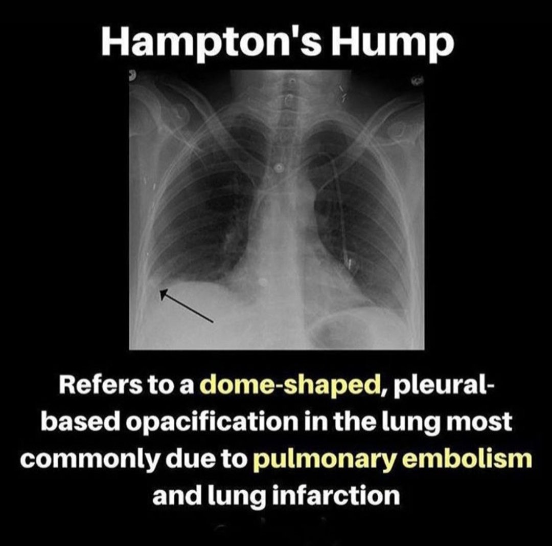 Pulmonary Infarction X Ray