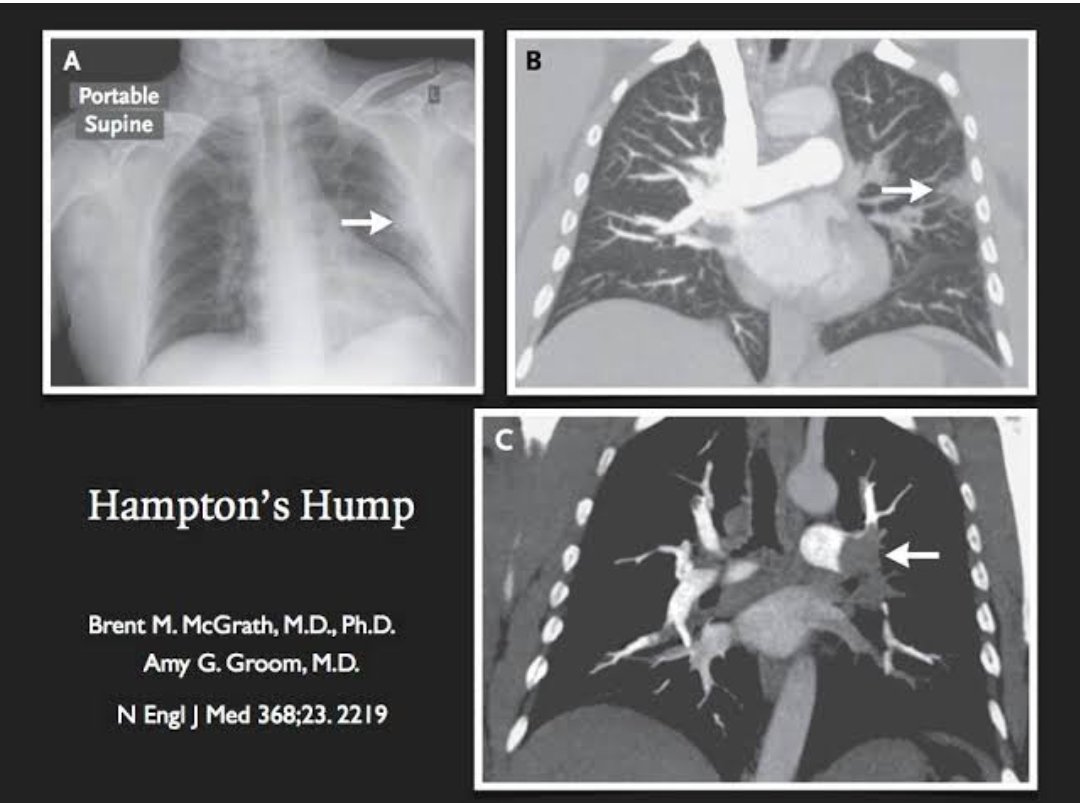 Pulmonary Embolism Hampton Hump A Classic Pulmonary Embolism: