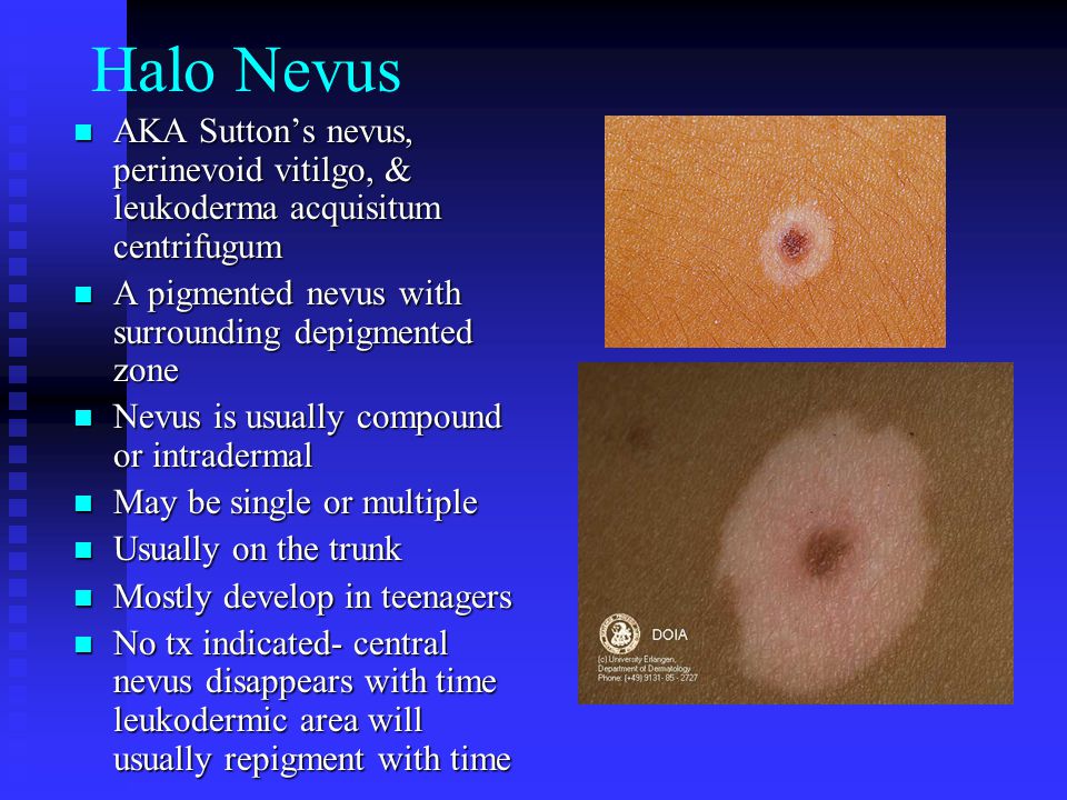 Halo Nevus