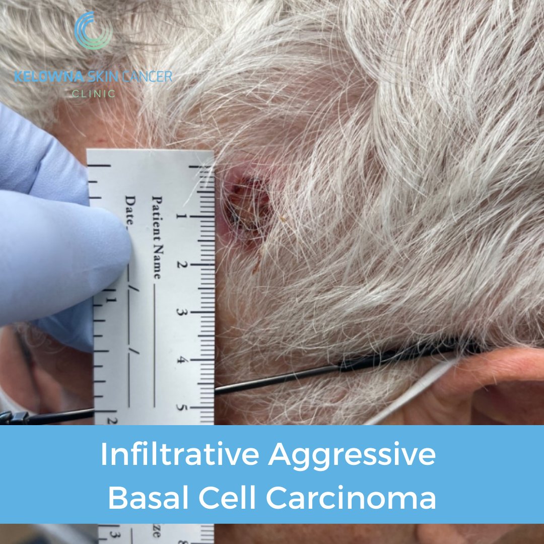 Basal Cell Carcinoma Dog