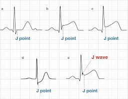 One of the most important diagnostic tests in Cardiology to interpret ...
