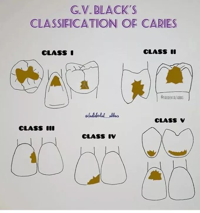 جالسة أسوي كشف ذاتي لأسناني وأدور أماكن التسوّسات ومدى خطورتها اللي ...