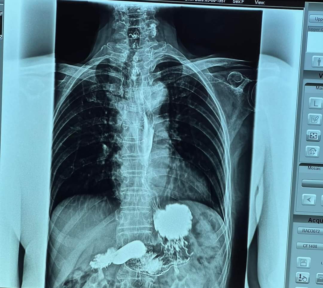 Giimaa 🥼 On Twitter Манай эмнэлэг хоол боловсруулах дээд доод замын давхар тодосгогчтой