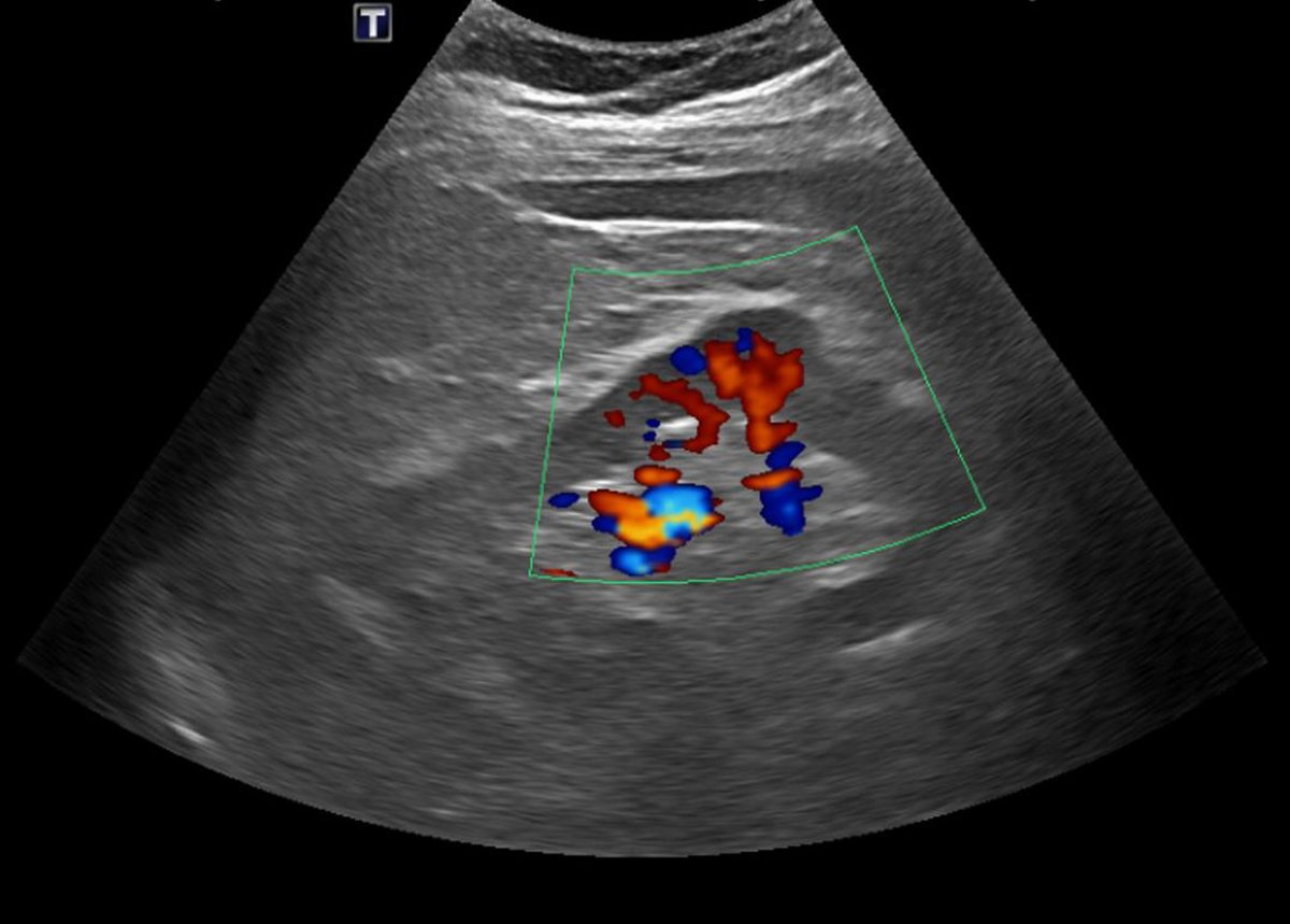 Kidney hump, no need to jump! Diagnosis? - Thread from Sthanu @Sthanu5 ...