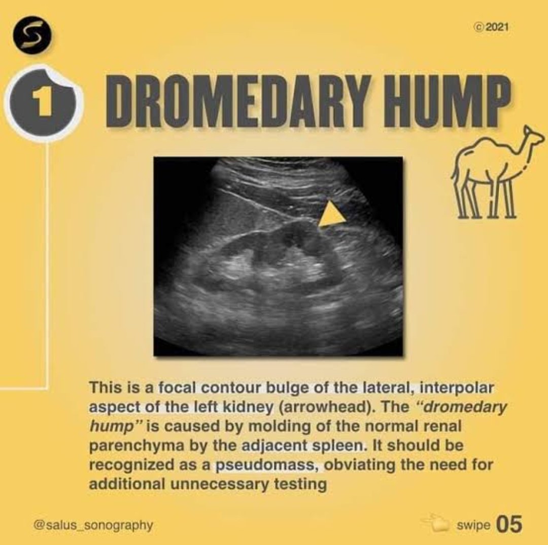 Kidney hump, no need to jump! Diagnosis? - Thread from Sthanu @Sthanu5 - Rattibha