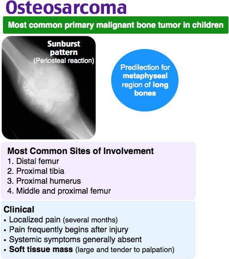 Osteosarcoma Sunray Appearance