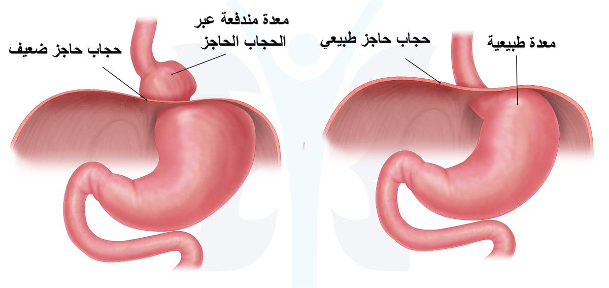 فتق الحجاب الحاجز يحدث الفتق الحجابي عندما ينتفخ الجزء العلوي من المعدة خلال العضلة الكبيرة التي