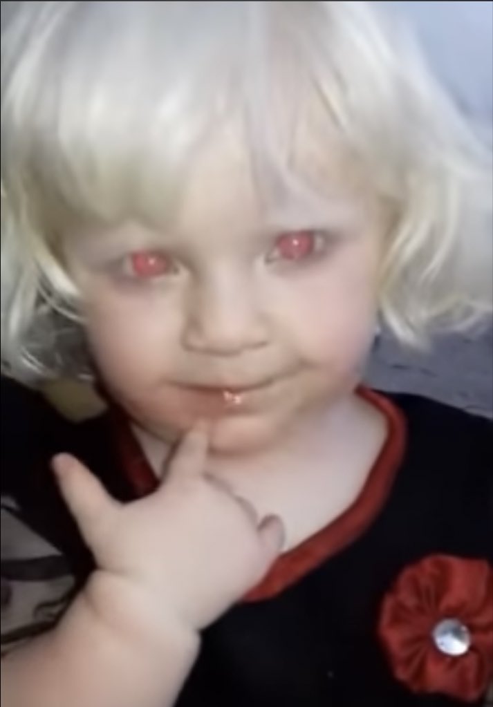 People Born With Red Eyes